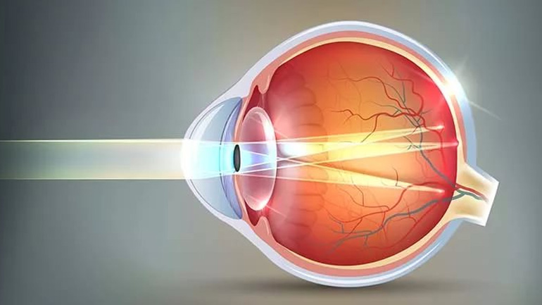 Astigmatismo | Valenia Health Services